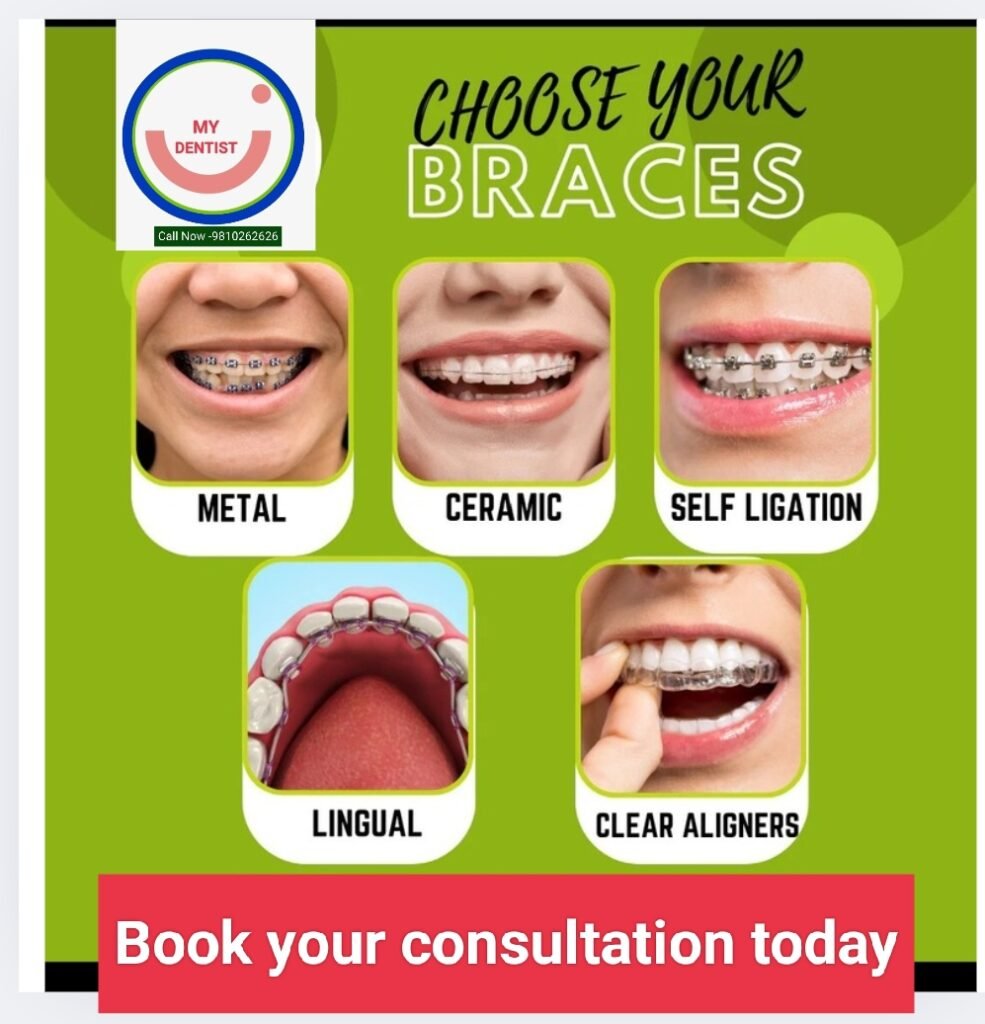 Ceramic Braces | Discreet, Effective Orthodontic Solution