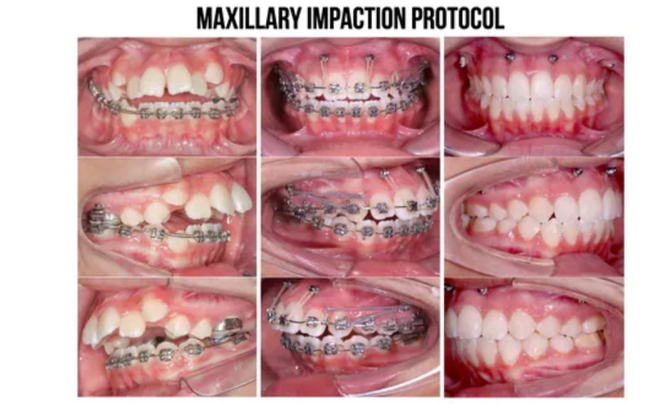 Ceramic Braces | Discreet, Effective Orthodontic Solution