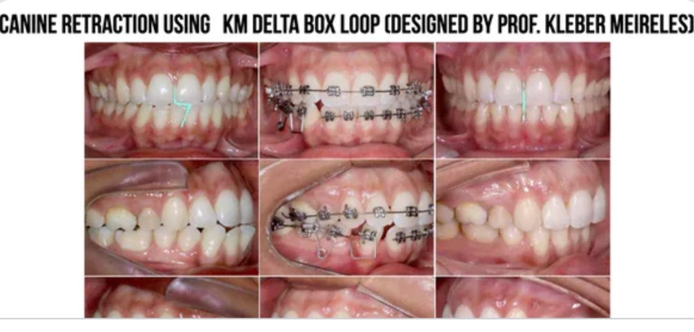 Ceramic Braces | Discreet, Effective Orthodontic Solution